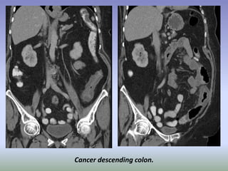 Presentation1.pptx, radiological imaging of large bowel diseases | PPTX