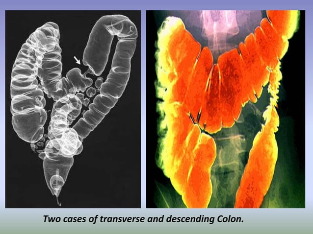 Presentation1.pptx, radiological imaging of large bowel diseases | PPTX ...