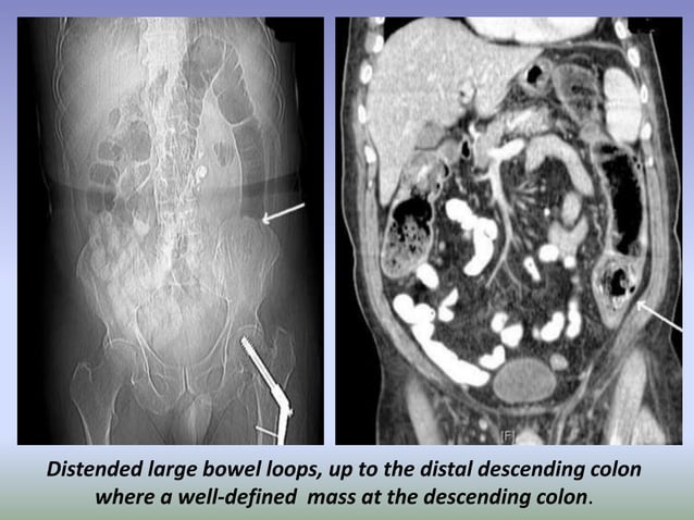 Presentation1.pptx, radiological imaging of large bowel diseases | PPTX ...