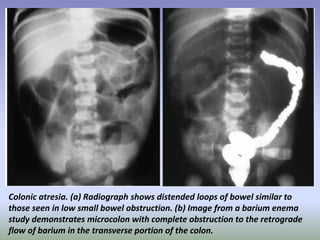 Presentation1.pptx, radiological imaging of large bowel diseases | PPTX