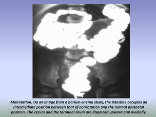 Presentation1.pptx, radiological imaging of large bowel diseases | PPT