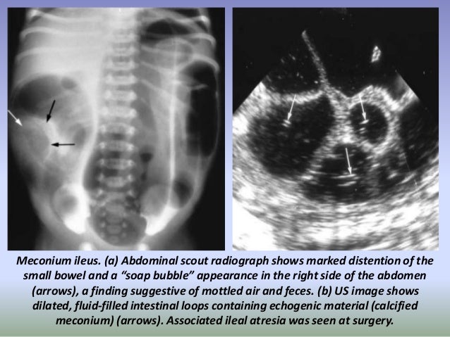 Presentation1.pptx, radiological imaging of large bowel diseases