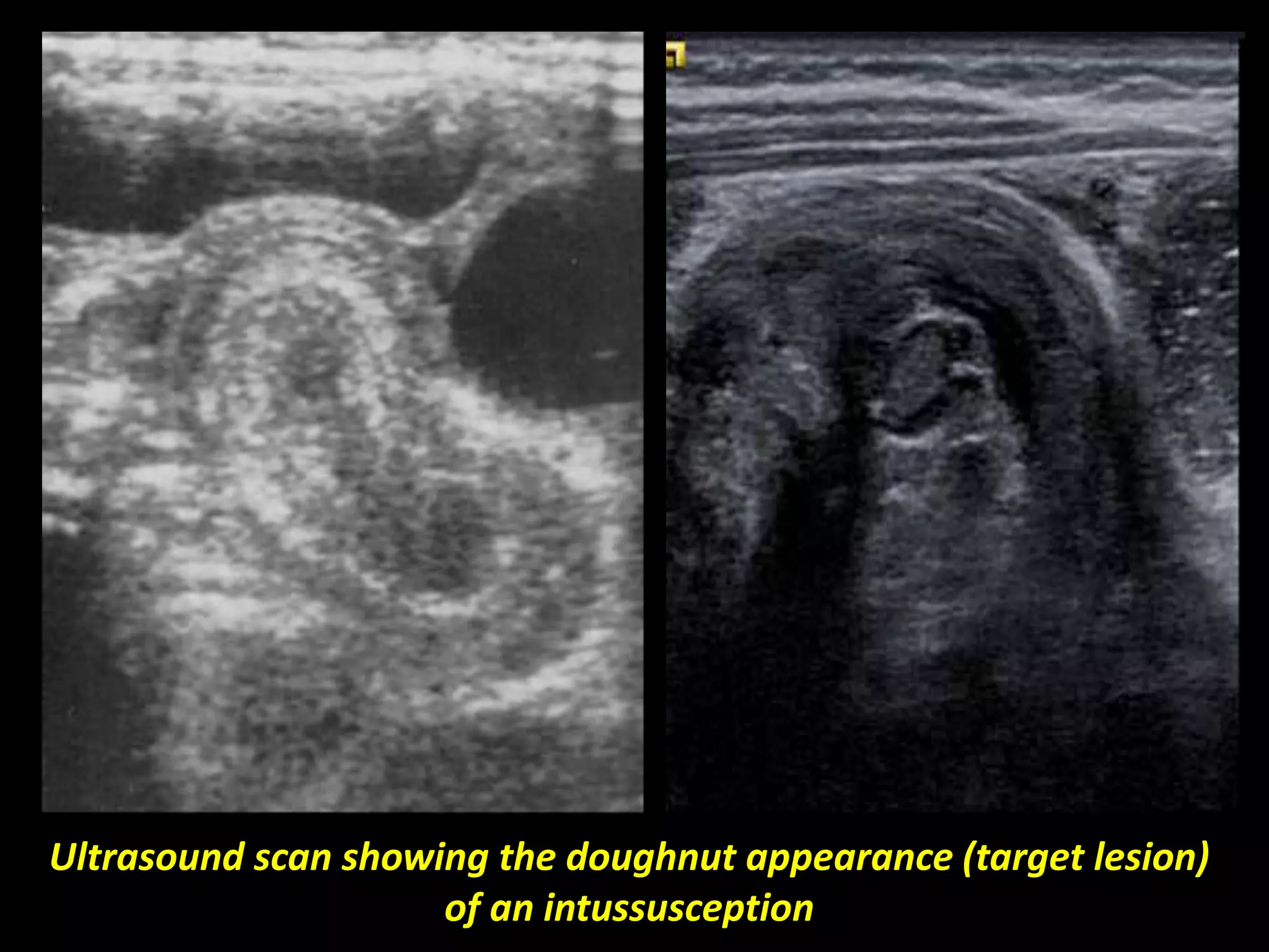 Presentation1.pptx, radiological imaging of intusussception. | PPTX