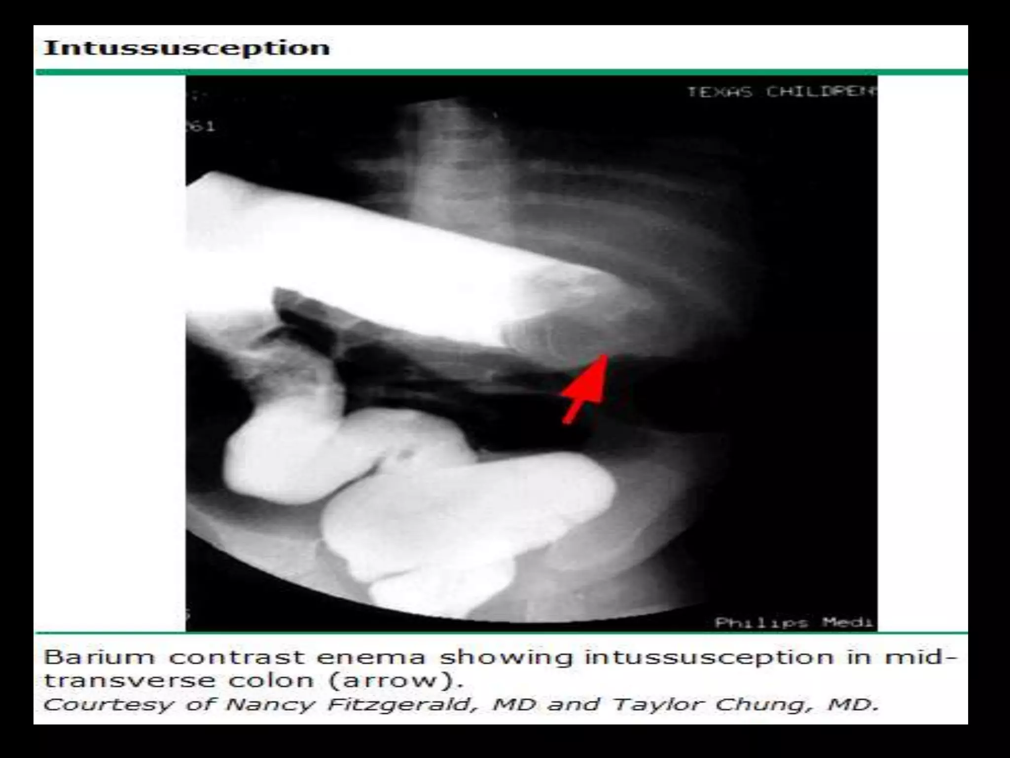 Presentation1.pptx, radiological imaging of intusussception. | PPTX