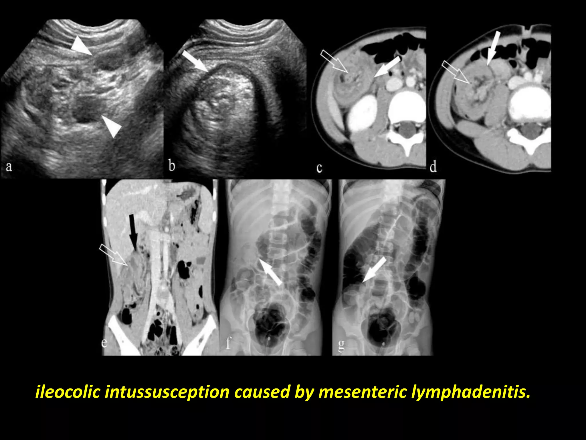 Presentation1.pptx, radiological imaging of intusussception. | PPTX