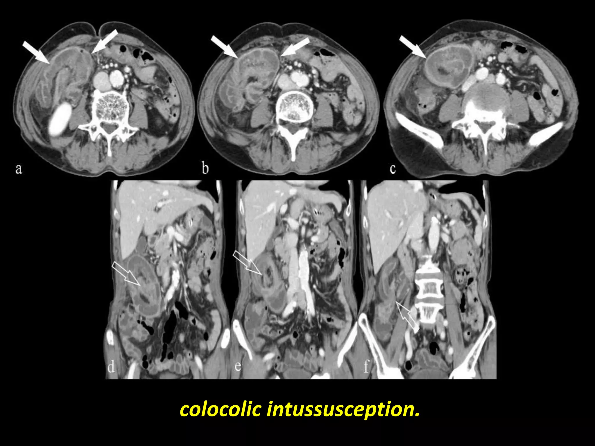 Presentation1.pptx, radiological imaging of intusussception. | PPTX