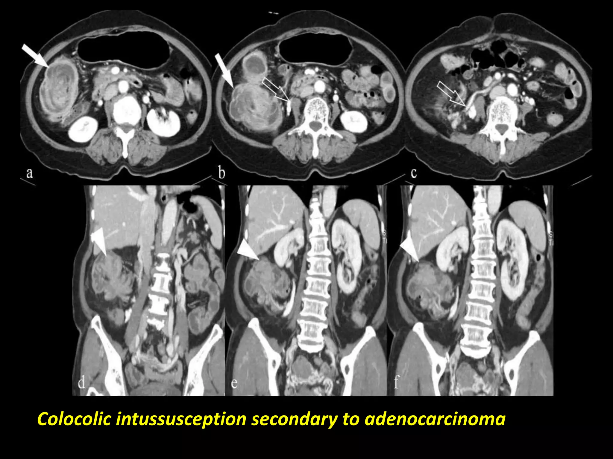 Presentation1.pptx, radiological imaging of intusussception. | PPTX