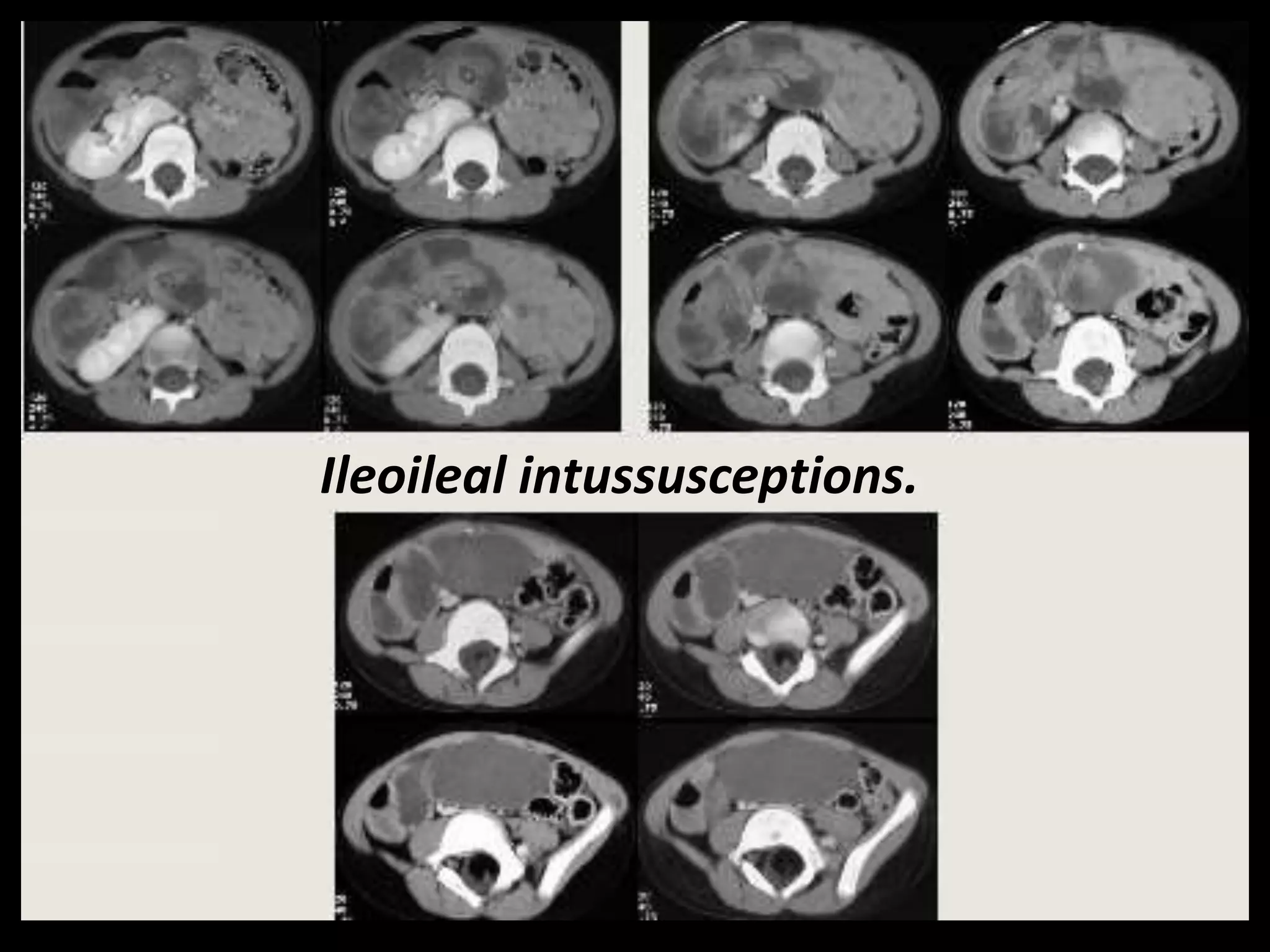 Presentation1.pptx, radiological imaging of intusussception. | PPTX