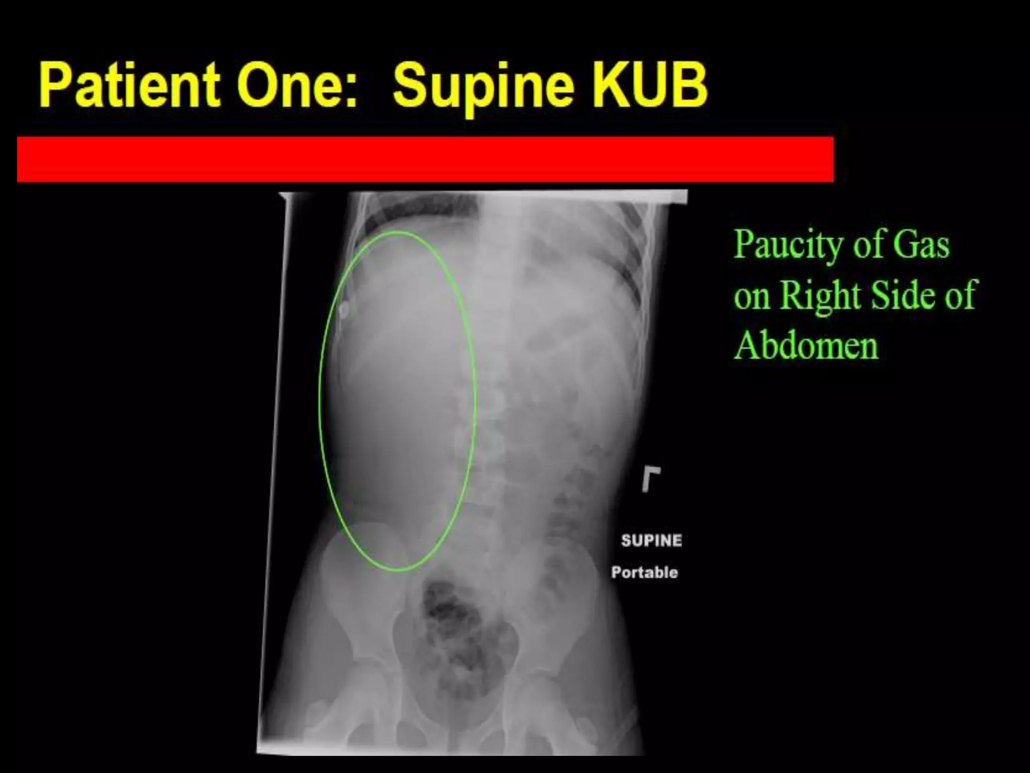 Presentation1.pptx, radiological imaging of intusussception. | PPTX