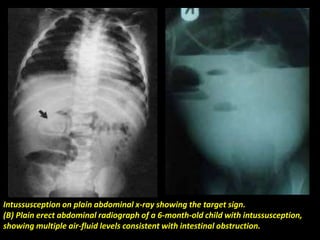 Presentation1.pptx, radiological imaging of intusussception. | PPTX