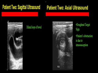 Presentation1.pptx, radiological imaging of intusussception. | PPTX