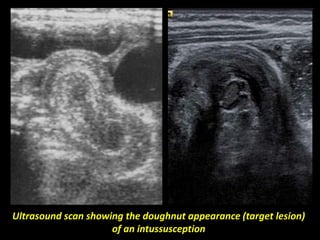 Presentation1.pptx, radiological imaging of intusussception. | PPTX