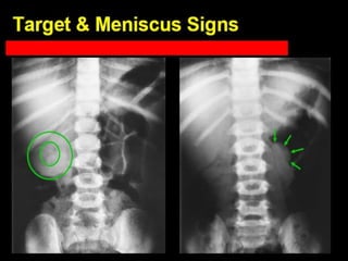 Intussusception X Ray Target Sign