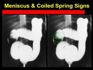 Barium Enema Intussusception