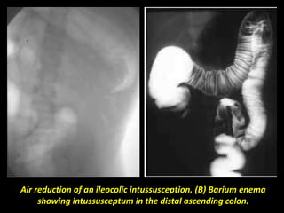 Presentation1.pptx, radiological imaging of intusussception. | PPT