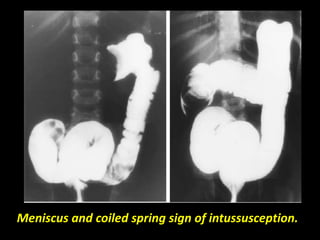 Presentation1.pptx, radiological imaging of intusussception. | PPT