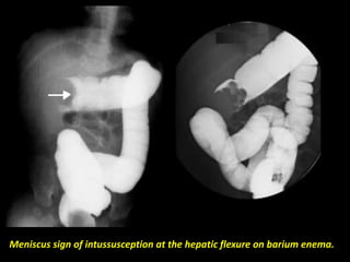 Presentation1.pptx, radiological imaging of intusussception. | PPT