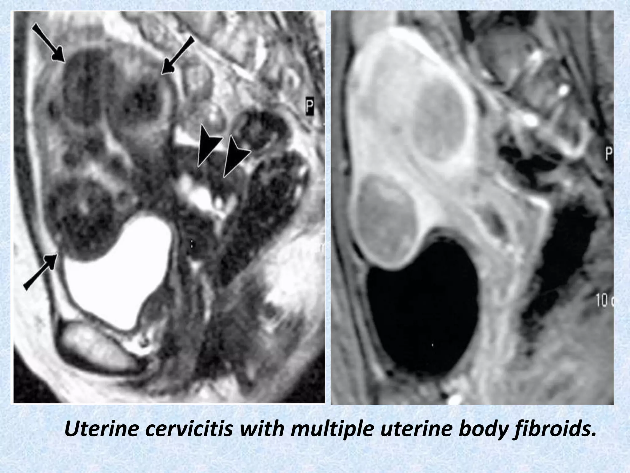 Presentation1.pptx, radiological imaging of uterine cervix diseases. | PPTX