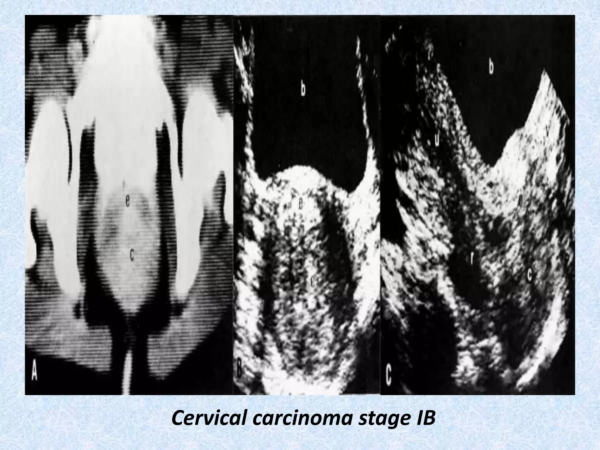 Presentation1.pptx, radiological imaging of uterine cervix diseases. | PPTX