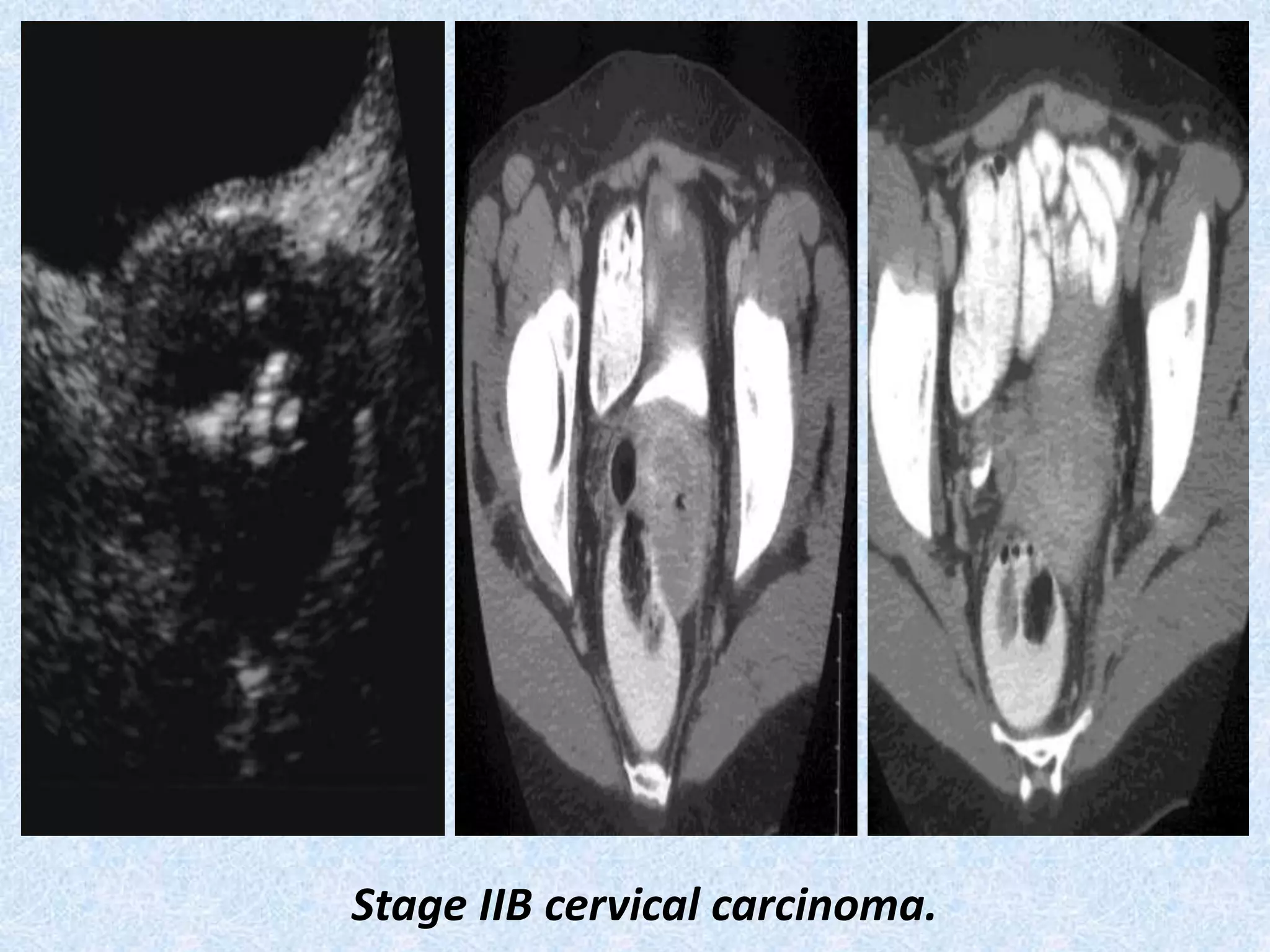 Presentation1.pptx, radiological imaging of uterine cervix diseases. | PPTX