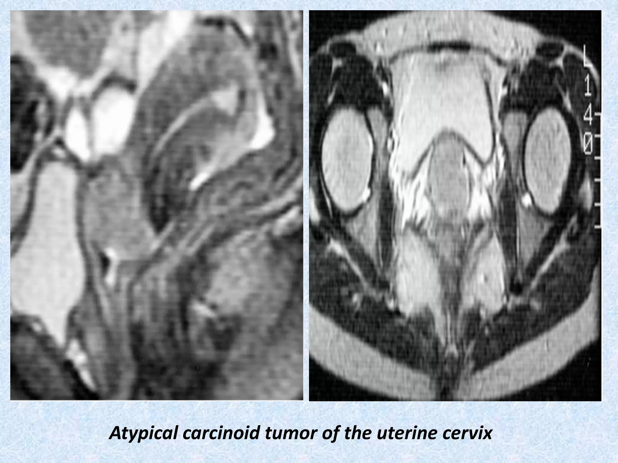 Presentation1.pptx, radiological imaging of uterine cervix diseases. | PPTX