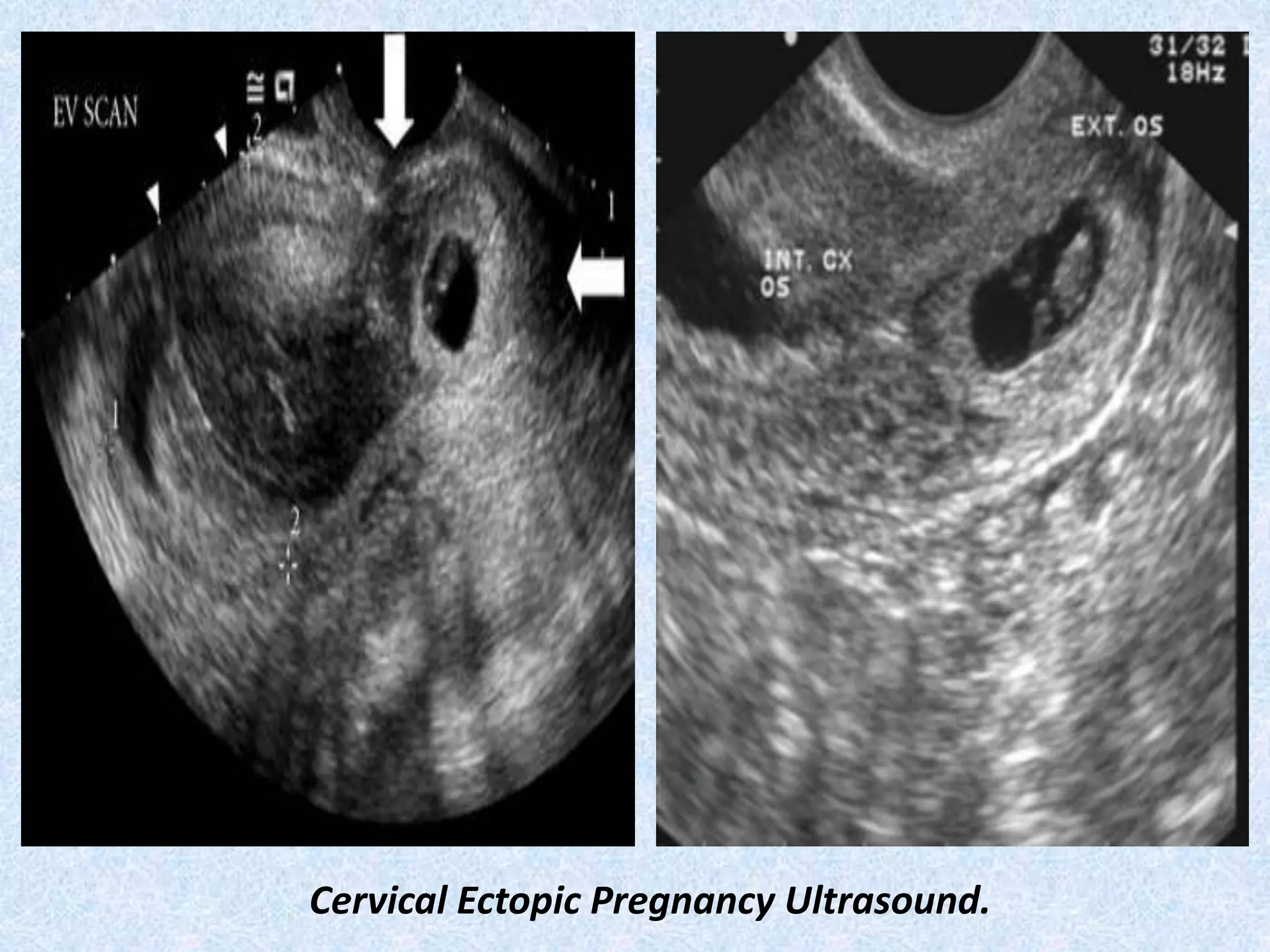 Presentation1.pptx, radiological imaging of uterine cervix diseases. | PPTX