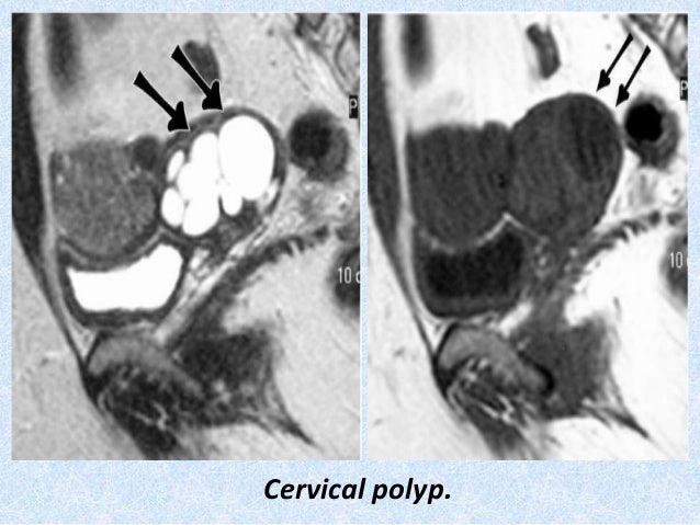 Pregnancy Cervical Polyp