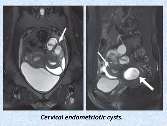 Bleeding Cyst On Cervix