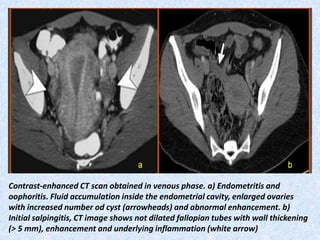 Presentation1.pptx, radiological imaging of uterine lesions. | PPTX