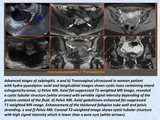Presentation1.pptx, radiological imaging of uterine lesions. | PPTX