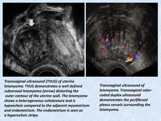 Presentation1.pptx, radiological imaging of uterine lesions. | PPTX