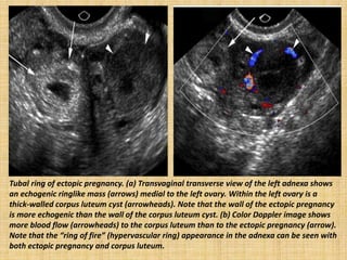 Presentation1.pptx, radiological imaging of ectopic pregancy. | PPTX