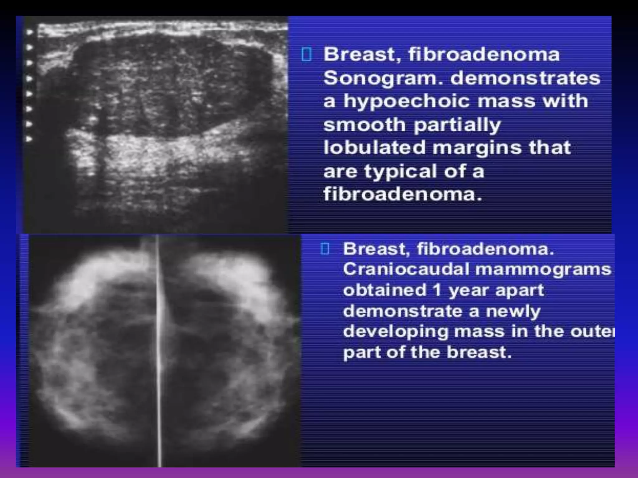 Presentation1.pptx, radiological imaging of beign breast diseases | PPTX