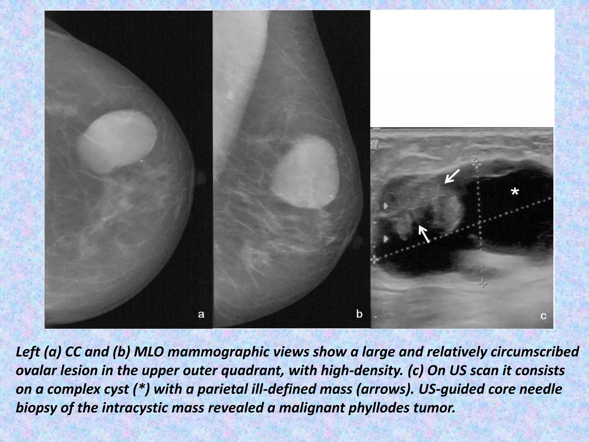 Presentation1.pptx, radiological imaging of malignant breast diseases ...
