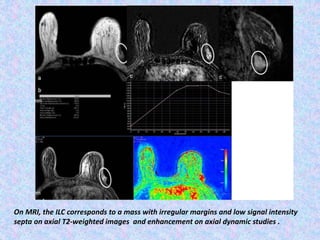 Presentation1.pptx, radiological imaging of malignant breast diseases ...