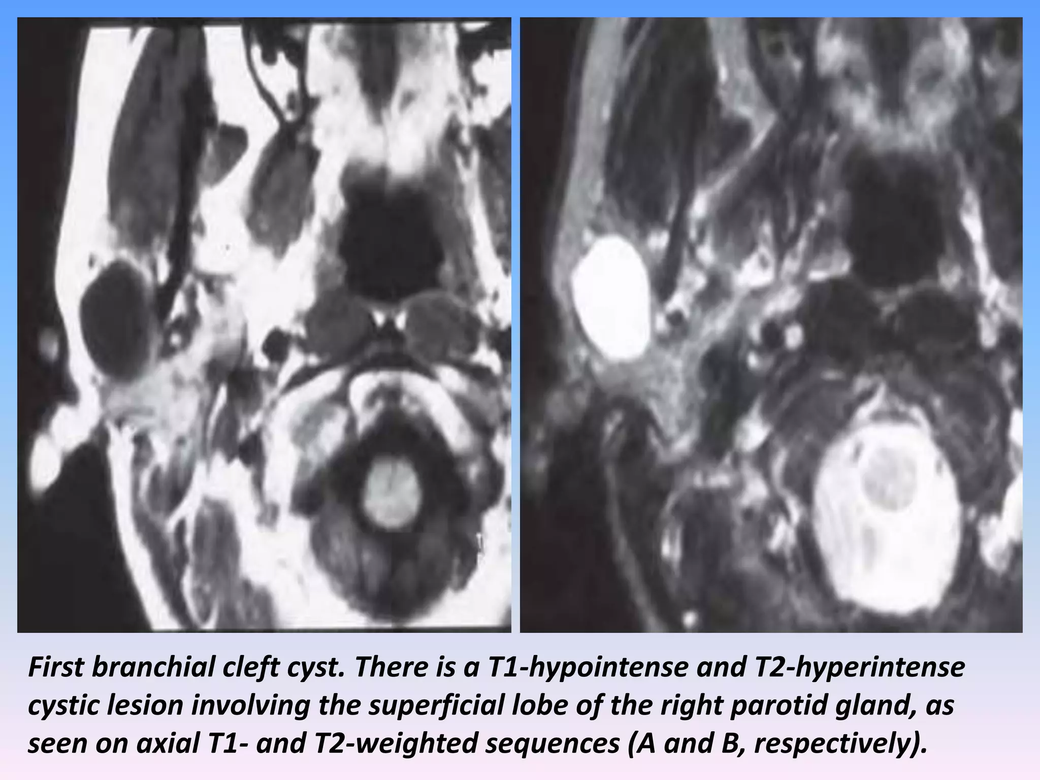 Presentation1.pptx, radiological imaging of pediatric neck masses. | PPTX