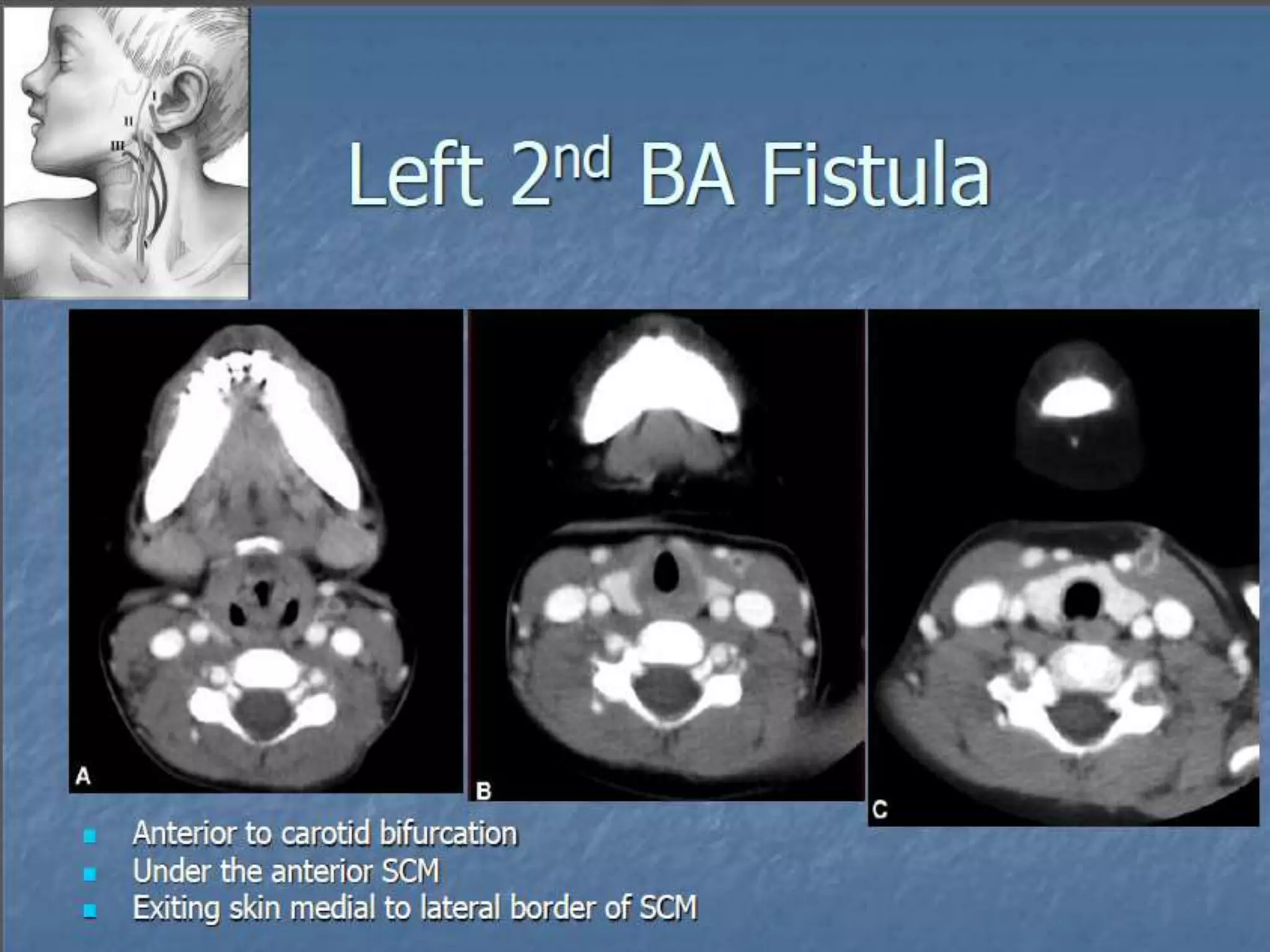 Presentation1.pptx, radiological imaging of pediatric neck masses. | PPTX