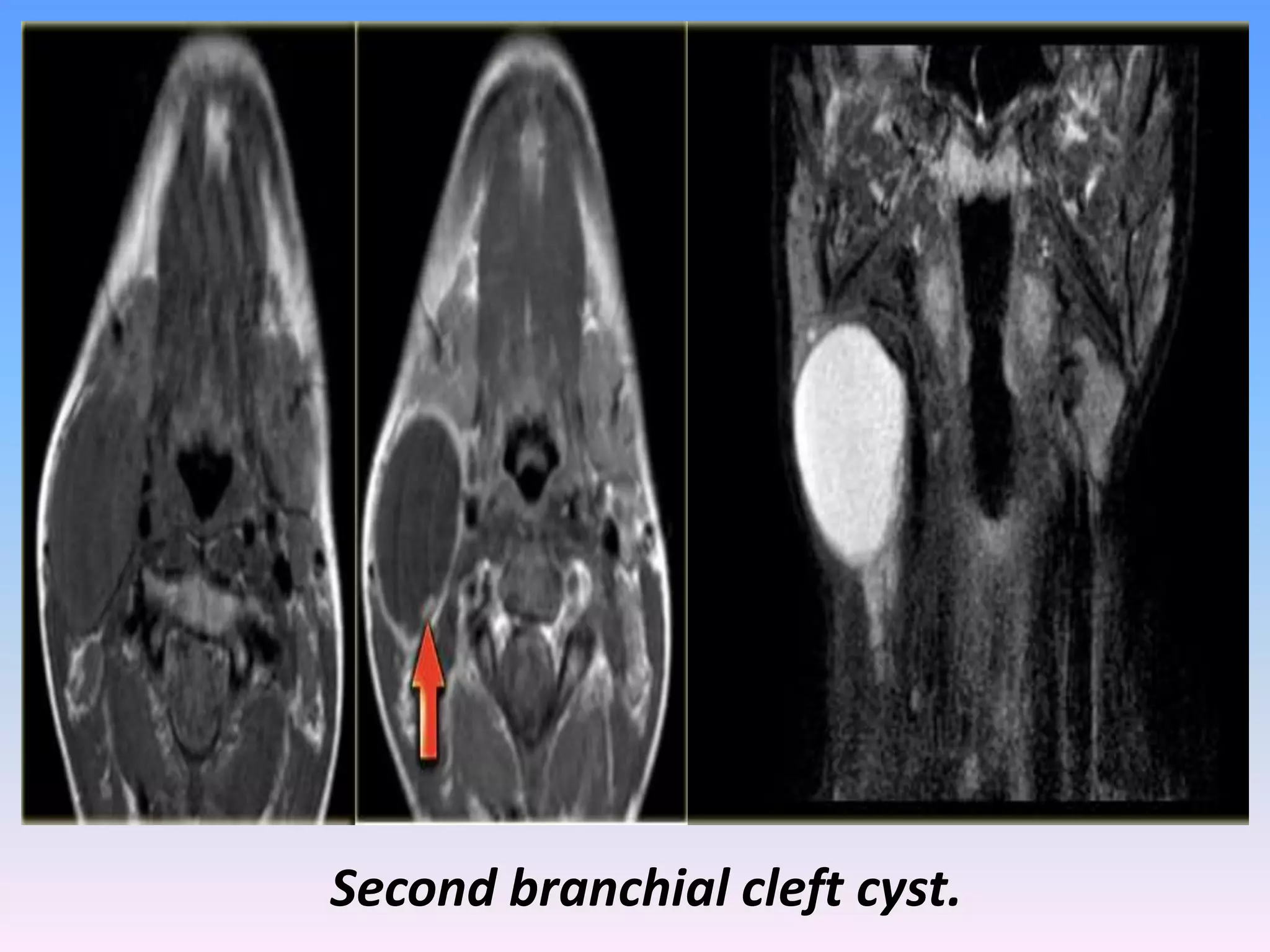 Presentation1.pptx, radiological imaging of pediatric neck masses. | PPTX
