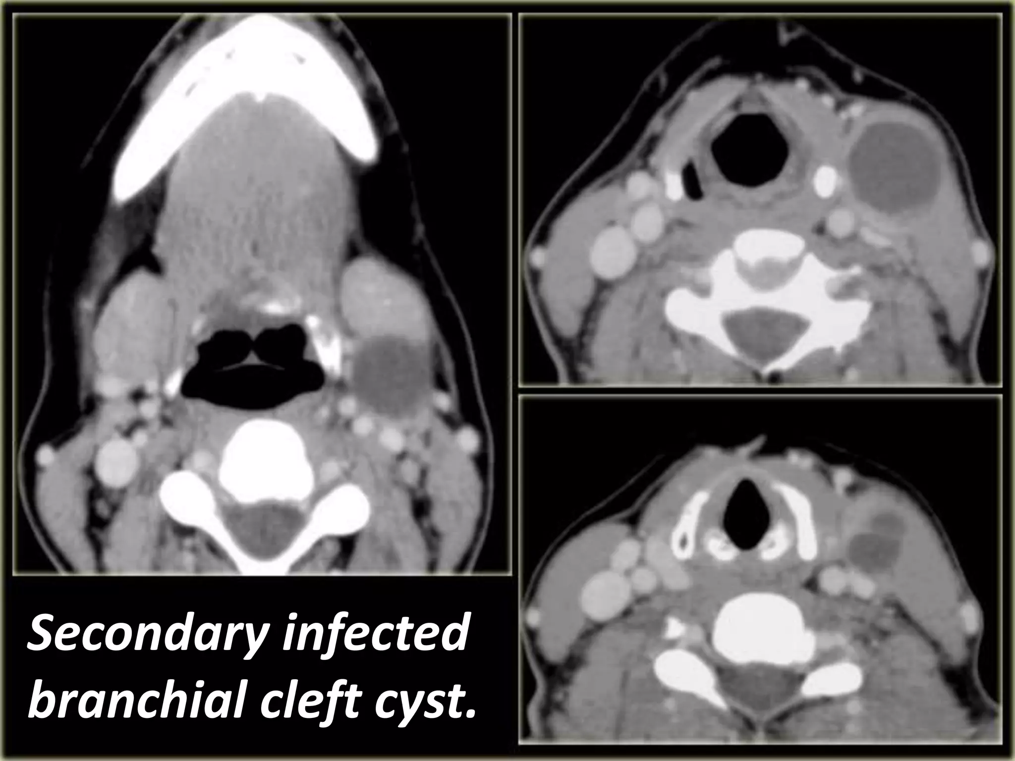 Presentation1.pptx, radiological imaging of pediatric neck masses. | PPTX