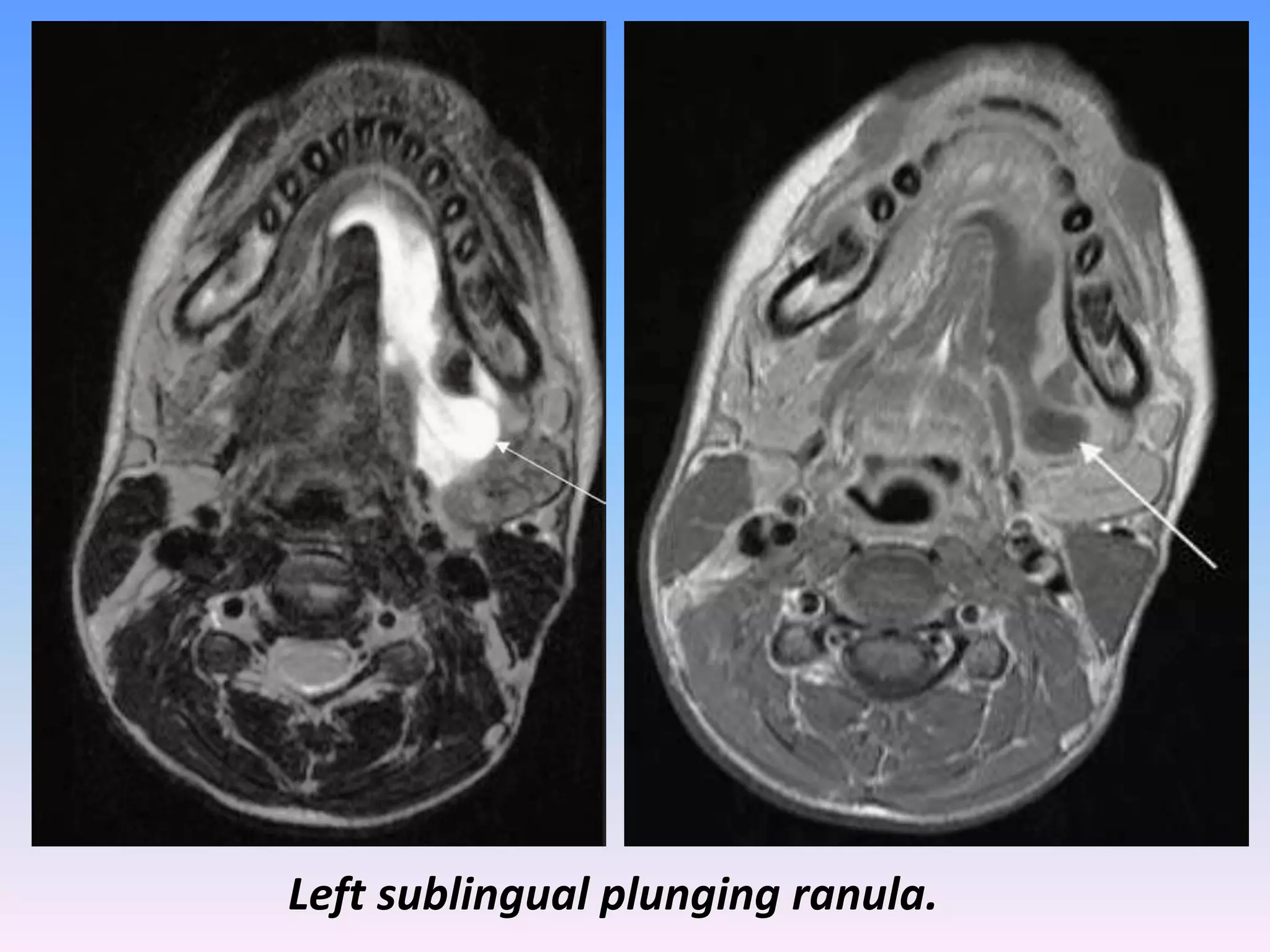 Presentation1.pptx, radiological imaging of pediatric neck masses. | PPTX