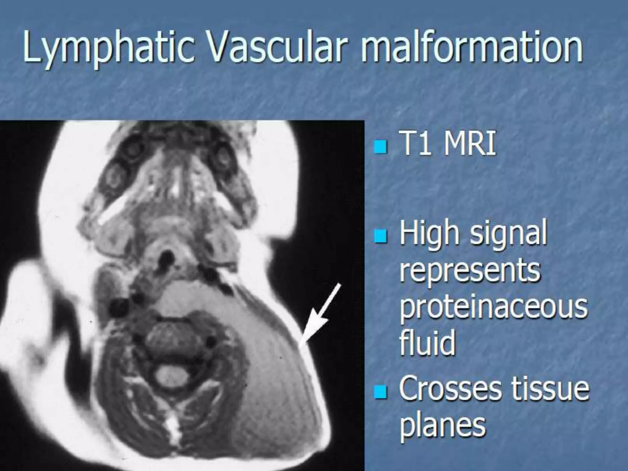 Presentation1 Pptx Radiological Imaging Of Pediatric Neck Masses Pptx