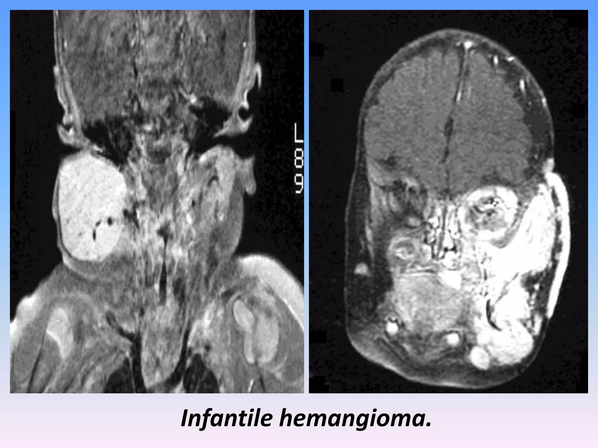 Presentation1.pptx, radiological imaging of pediatric neck masses. | PPTX