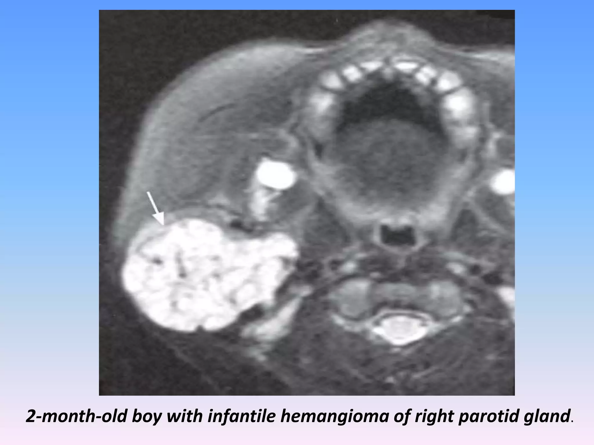 Presentation1.pptx, radiological imaging of pediatric neck masses. | PPTX