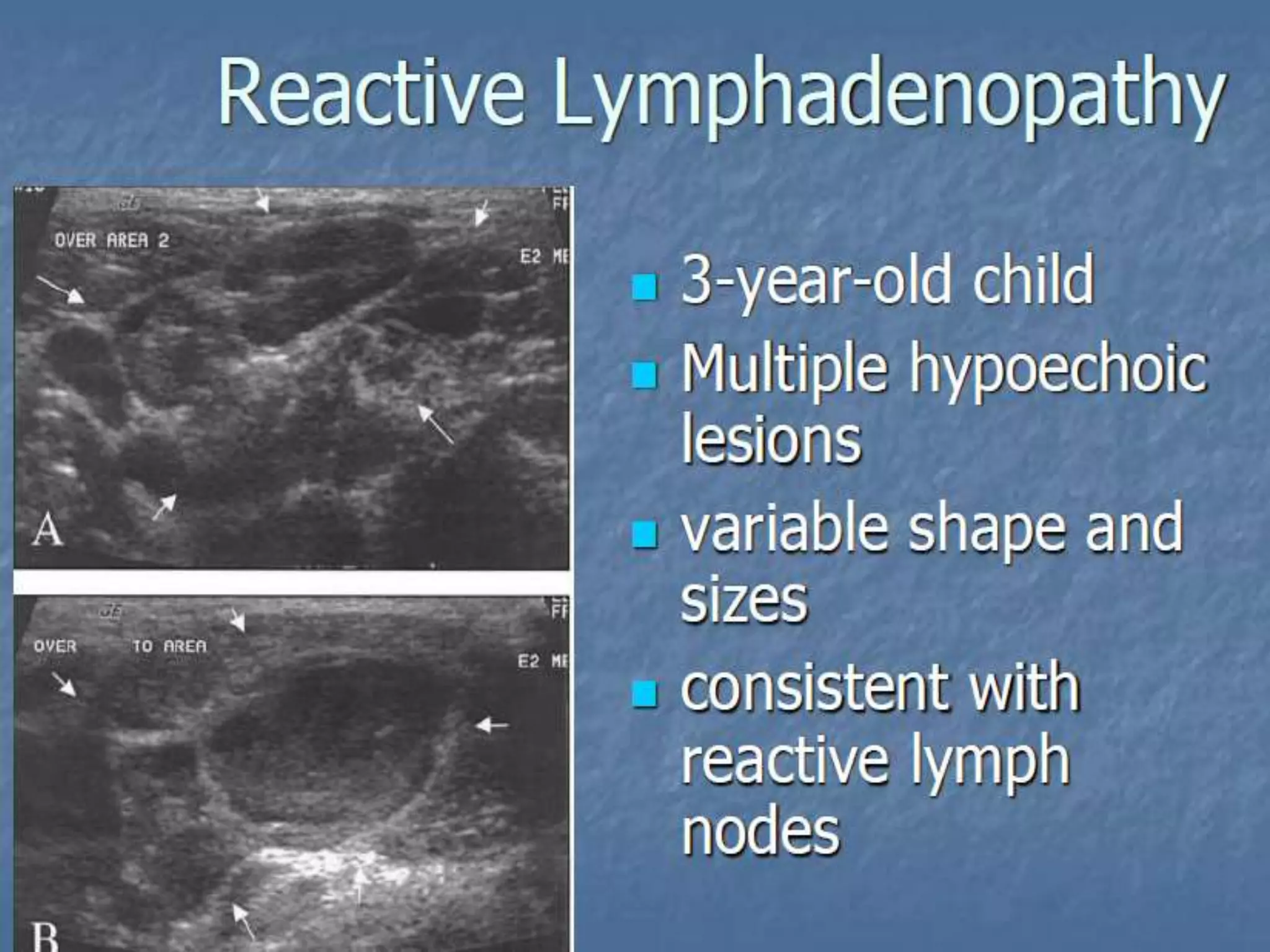 Presentation1.pptx, radiological imaging of pediatric neck masses. | PPTX
