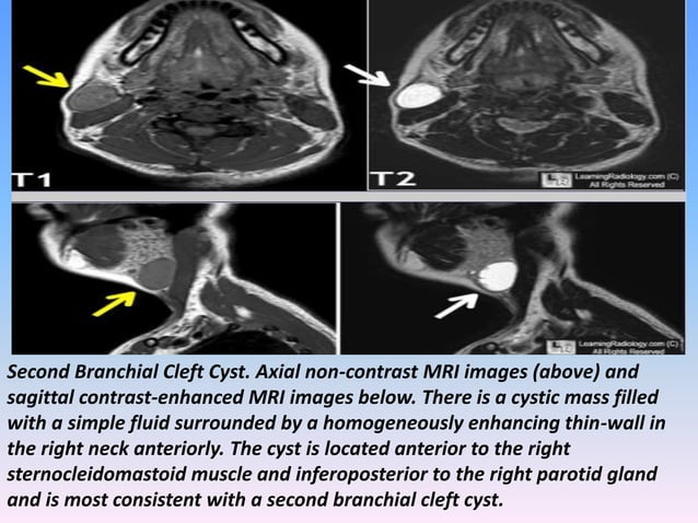 Presentation1.pptx, radiological imaging of pediatric neck masses ...