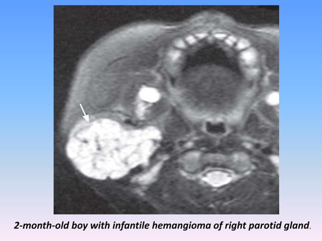 Presentation1.pptx, radiological imaging of pediatric neck masses ...