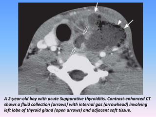 Presentation1.pptx, radiological imaging of pediatric neck masses. | PPTX