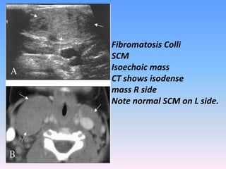 Presentation1.pptx, radiological imaging of pediatric neck masses. | PPTX