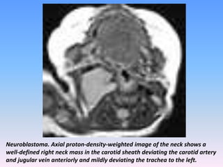 Presentation1.pptx, radiological imaging of pediatric neck masses. | PPTX