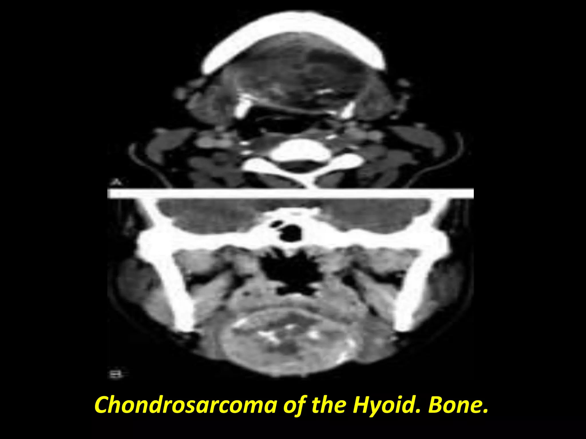 Presentation1.pptx, radiological imaging of adult neck masses. | PPTX